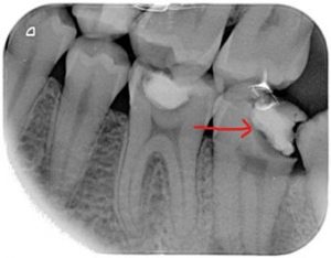 La importancia del control radiográfico para las caries