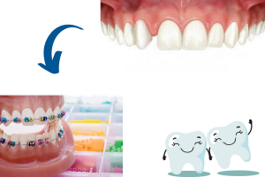 ¿Qué es la agenesia dental? Causas y tratamientos - Clínica Gonzalvo